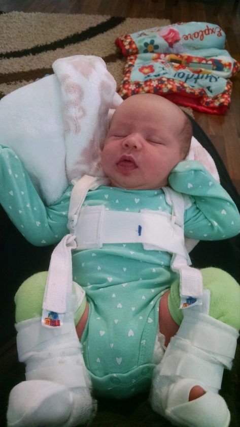 Baby & Braces: Our Hip Dysplasia Diagnosis